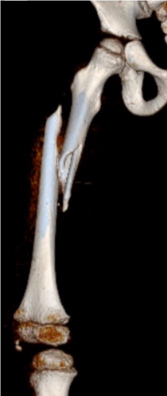 femur fractures | The Bone School