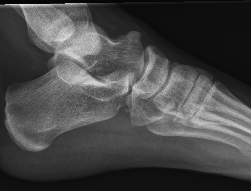 Tarsal Coalition | The Bone School