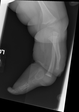 Tibial Hemimelia | The Bone School