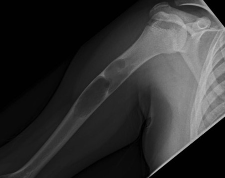 Unicameral Bone Cyst | The Bone School