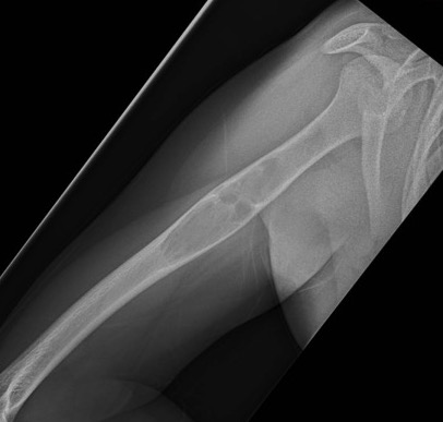 Unicameral Bone Cyst | The Bone School