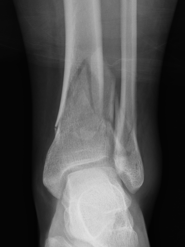 Distal Tibial Fractures | The Bone School