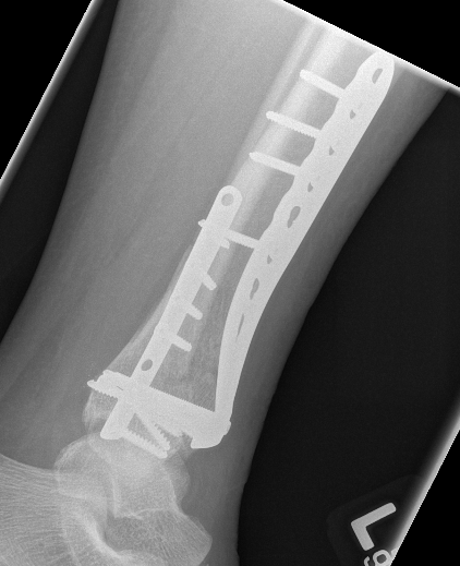 Distal Tibial Fractures | The Bone School