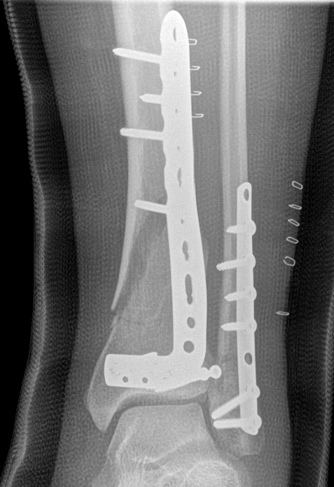 Distal Tibial Fractures | The Bone School