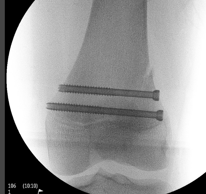 Distal Femoral Physeal Injuries | The Bone School