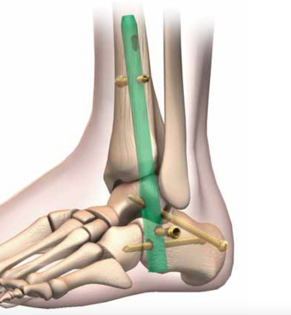 Pantalar and Hindfoot Arthrodesis | The Bone School