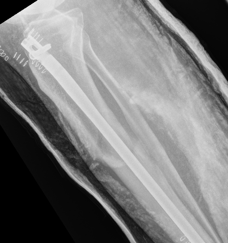 Proximal Tibial Fractures | The Bone School