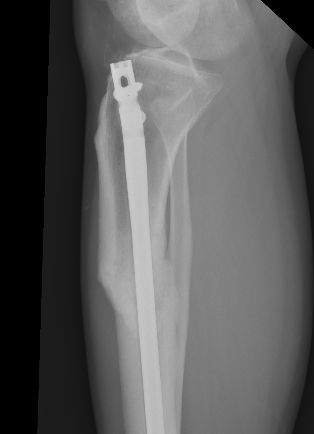 Proximal Tibial Fractures | The Bone School