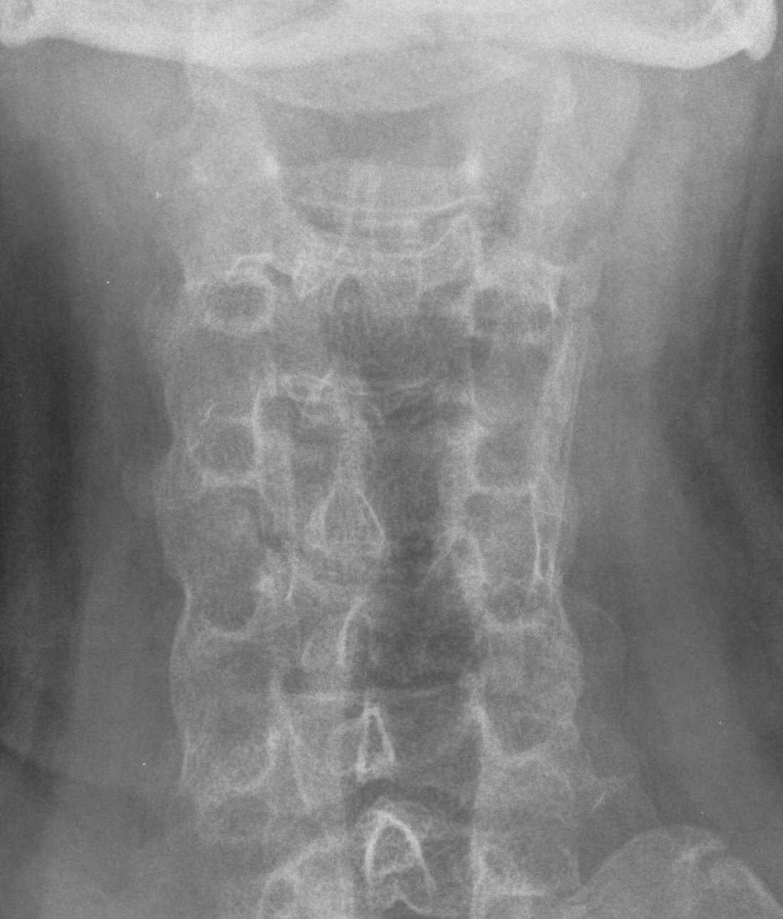 Cervical Ankylosing Spondylitis X Ray