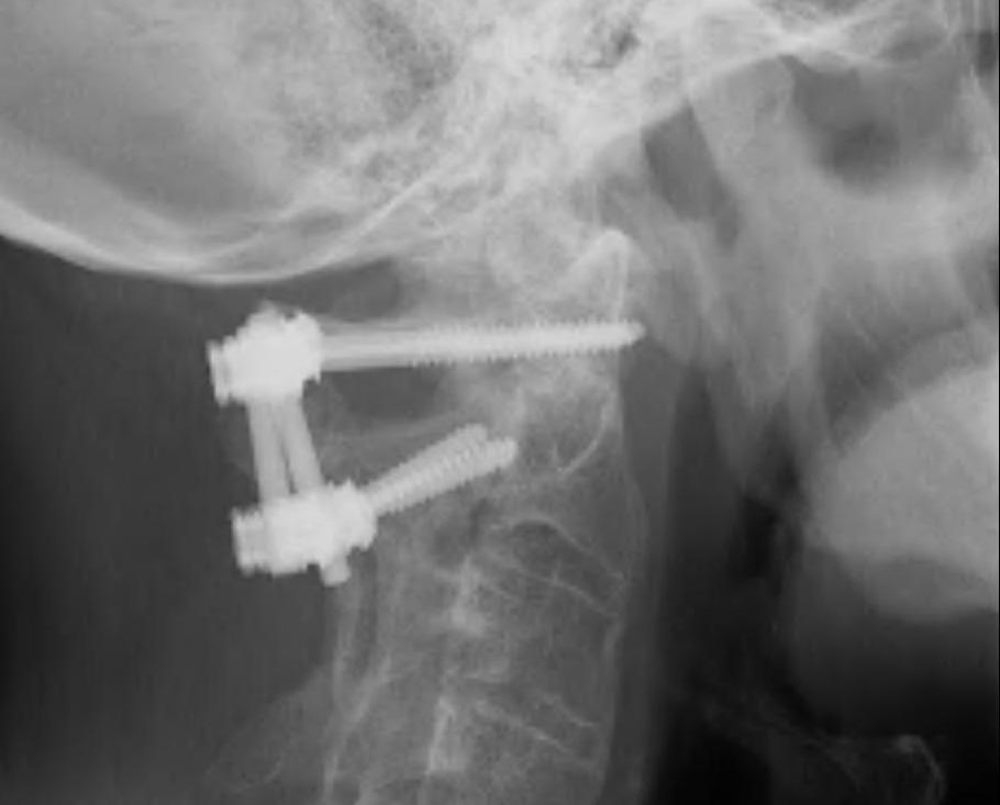 Dens / Odontoid Fracture | The Bone School