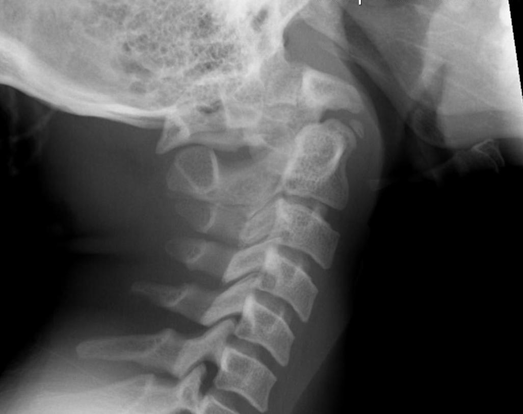 Dens / Odontoid Fracture | The Bone School