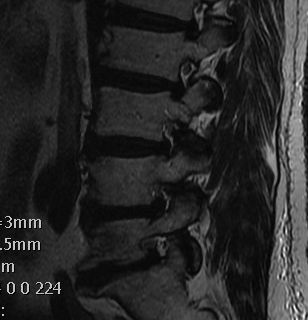 Lumbar Herniated Discs | The Bone School