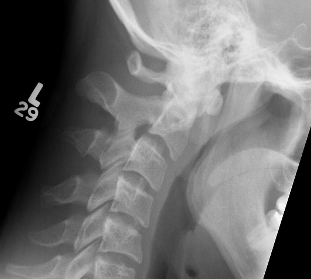 Classification Fractures Atlas Jefferson Fracture Bone Jefferson