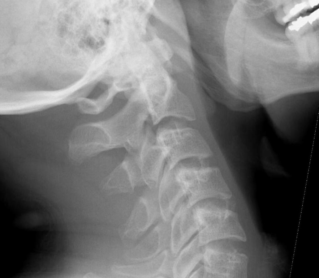 Atlas / C1 Fractures | The Bone School