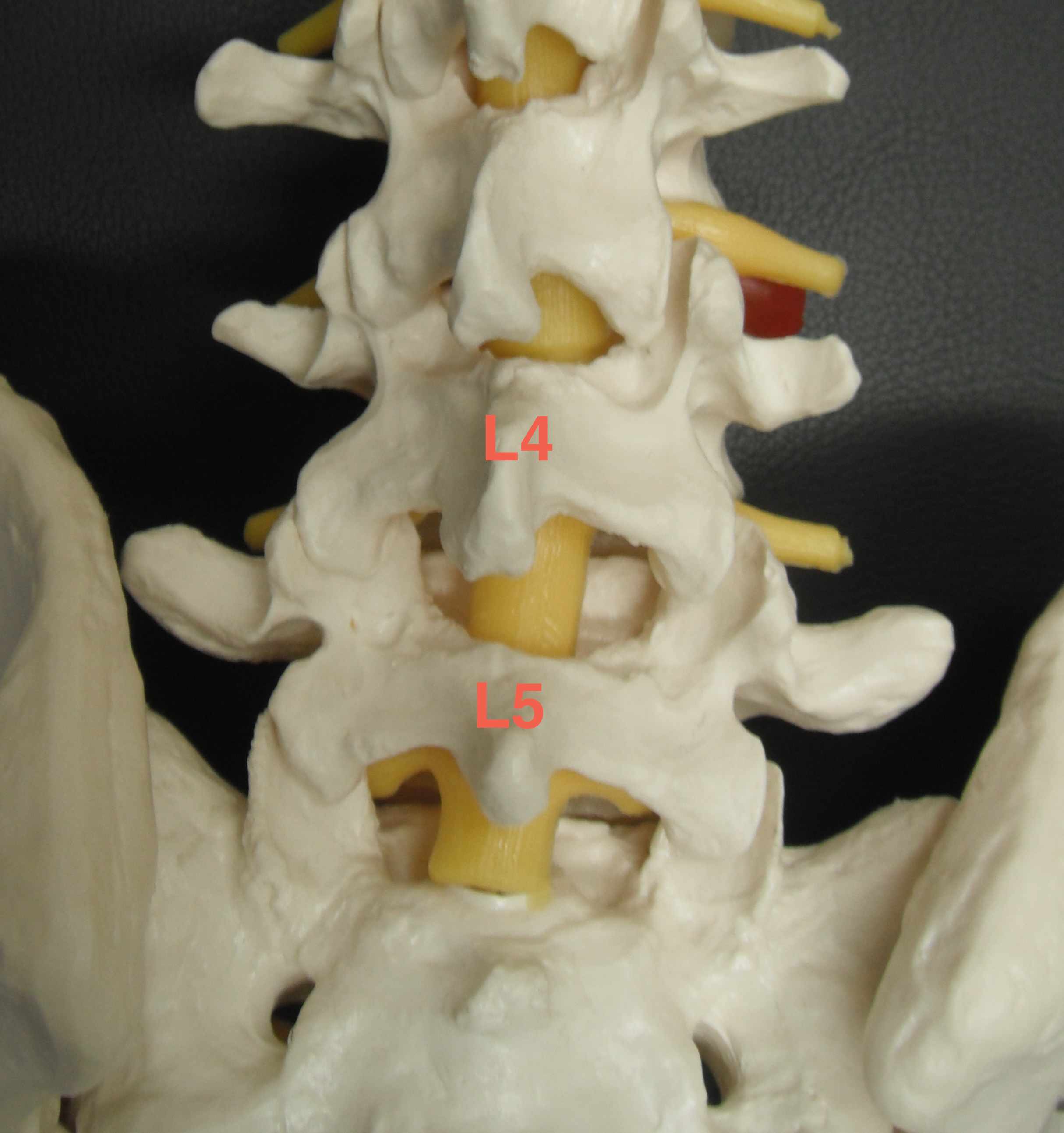 Lumbar Stenosis | The Bone School
