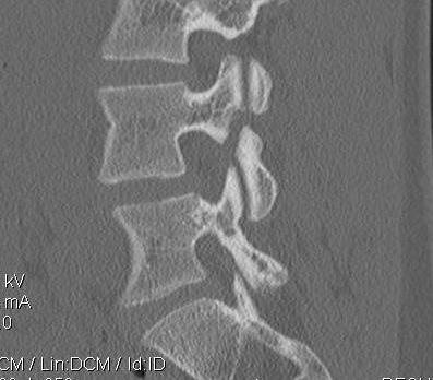 Spondylolisthesis Dyplastic Isthmic | The Bone School