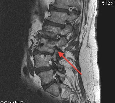 Lumbar Stenosis | The Bone School