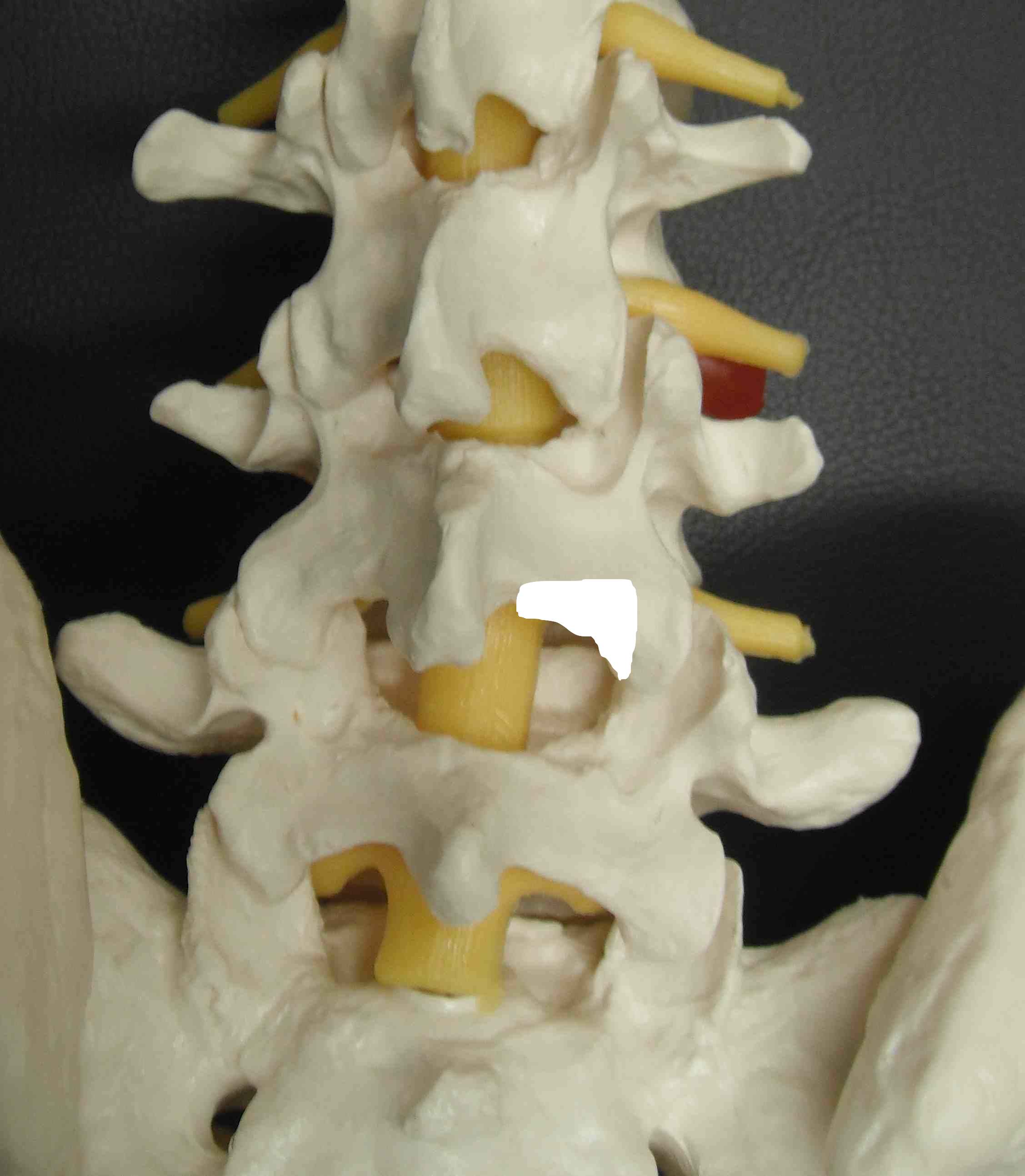 Lumbar Discectomy Techniques | The Bone School