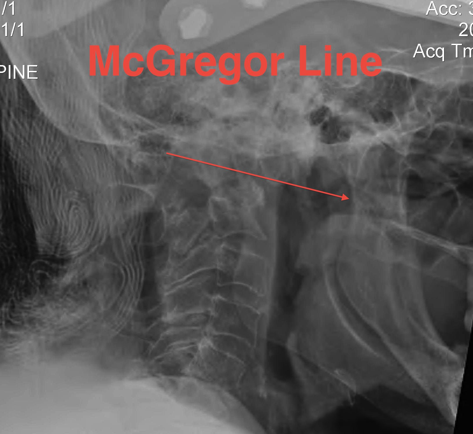 Rheumatoid Neck | The Bone School
