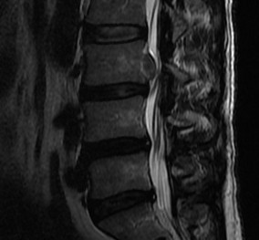 Lumbar Herniated Discs | The Bone School