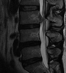 Lumbar Herniated Discs | The Bone School