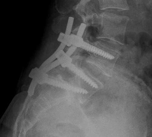 Spondylolisthesis Dyplastic Isthmic | The Bone School