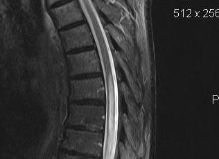 Syringomyelia | The Bone School