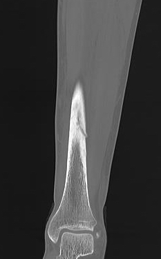 Tibial Stress Fractures | The Bone School