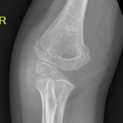 Supracondylar fractures | The Bone School