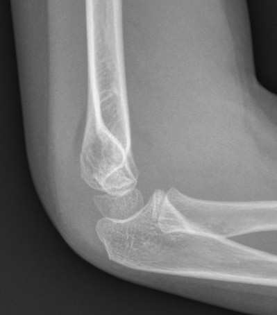 Supracondylar fractures | The Bone School