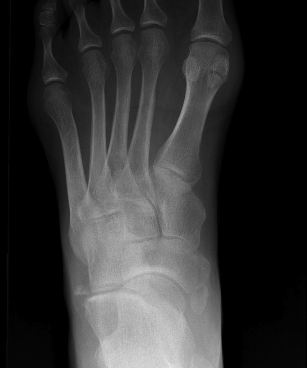 Accessory Navicular | The Bone School