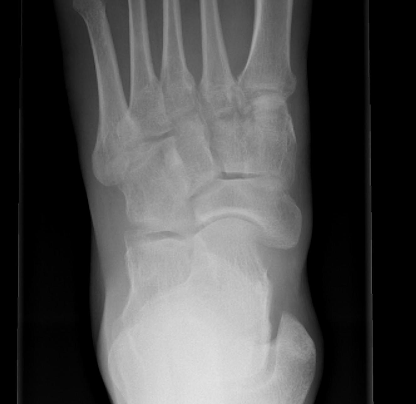 Accessory Navicular | The Bone School