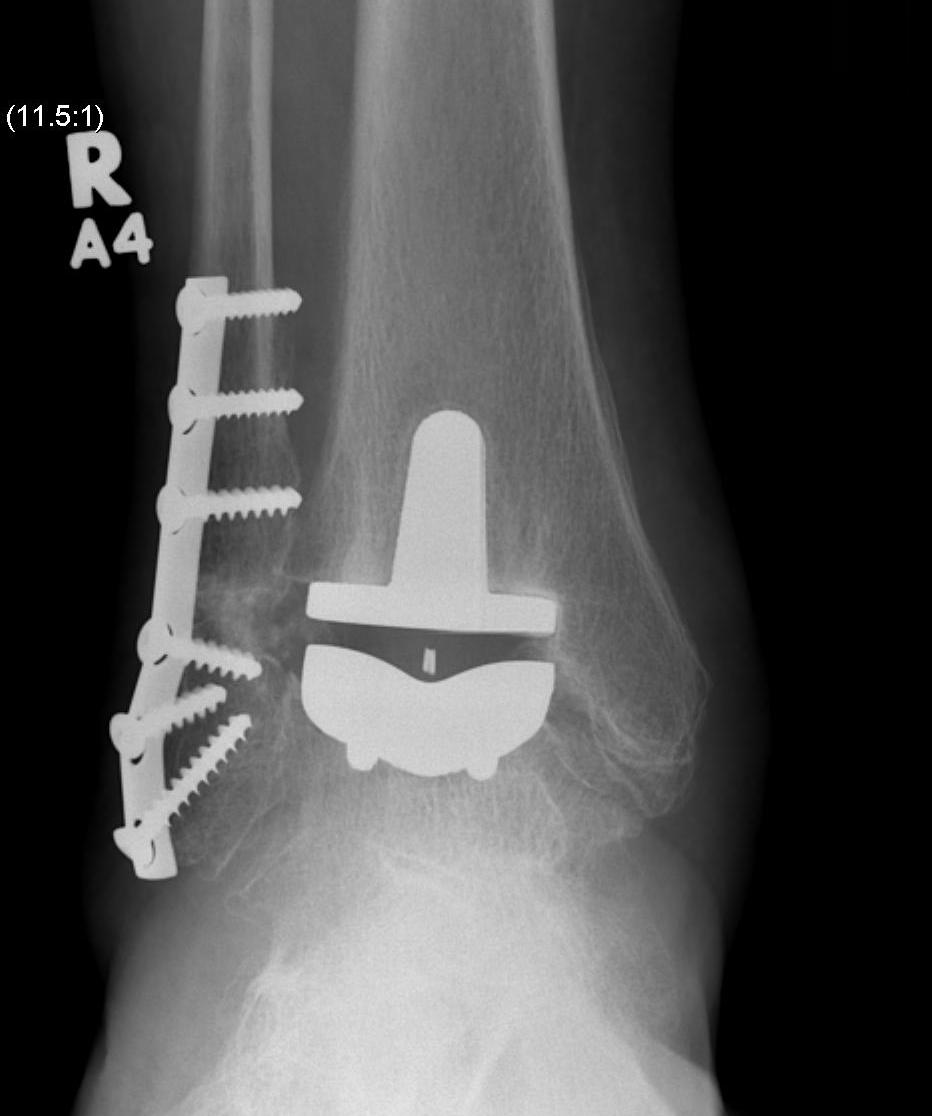 Ankle Arthroplasty | The Bone School