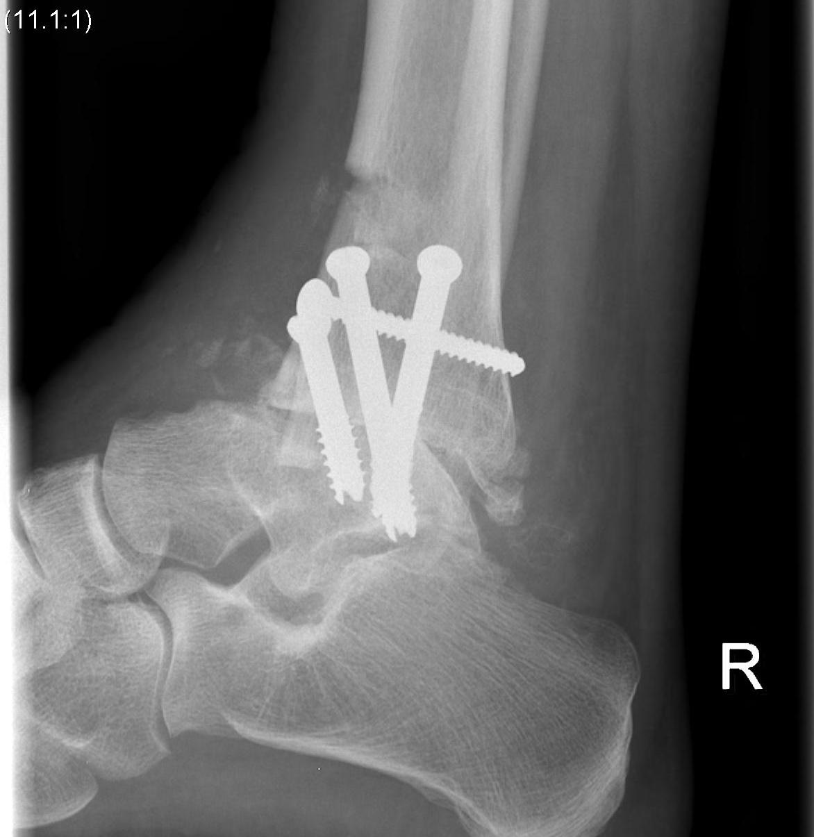 Talar neck complications | The Bone School