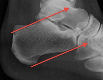 Insertional Achilles Tendinopathy | The Bone School