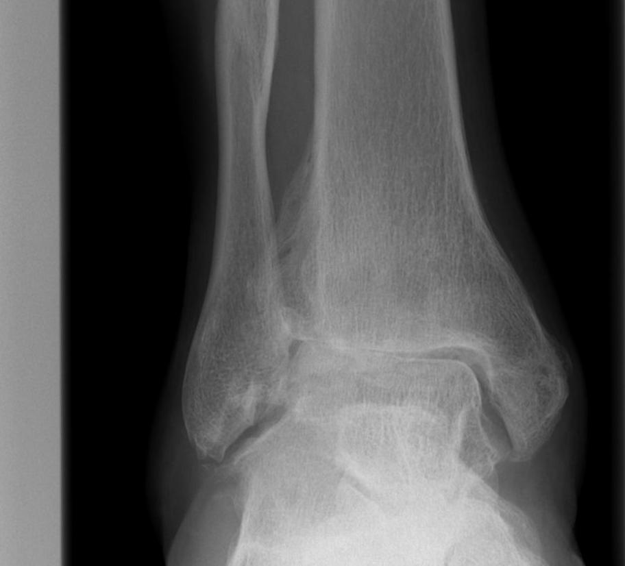 Ankle Osteoarthritis | The Bone School