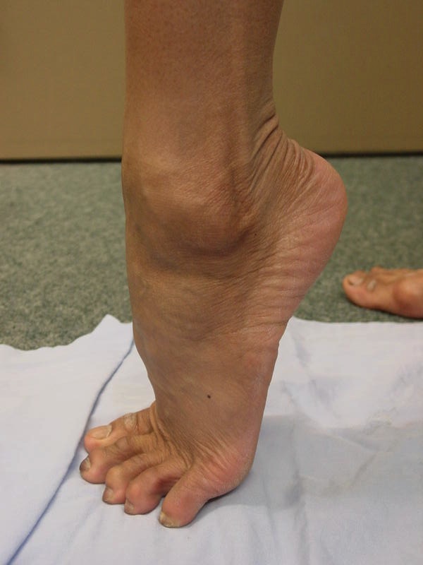 Subluxation / Dislocation | The Bone School