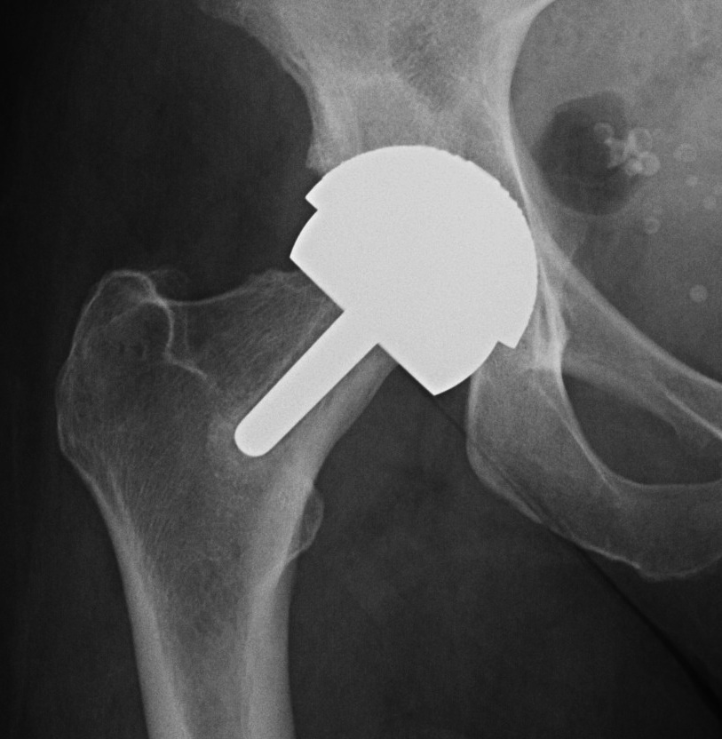 Resurfacing | The Bone School