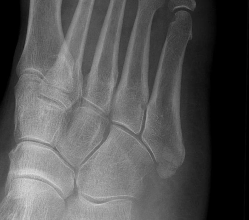 Metatarsal Fractures | The Bone School