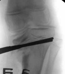 Blount's Disease | The Bone School