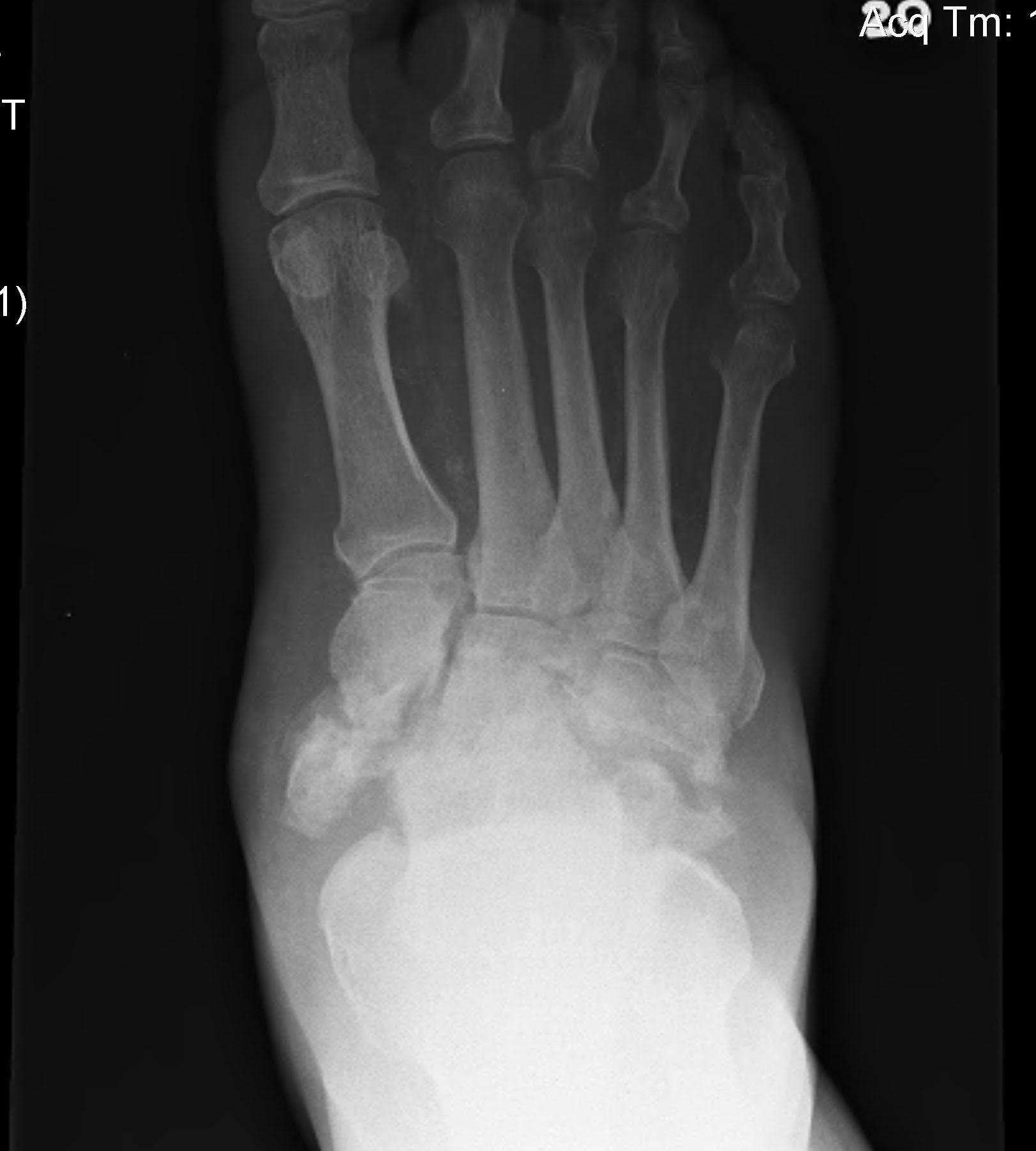 Charcot Foot & Ankle | The Bone School