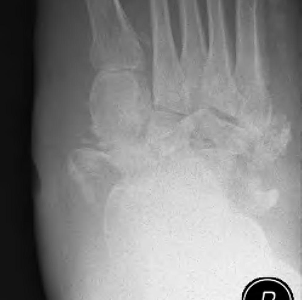 Charcot Foot & Ankle | The Bone School