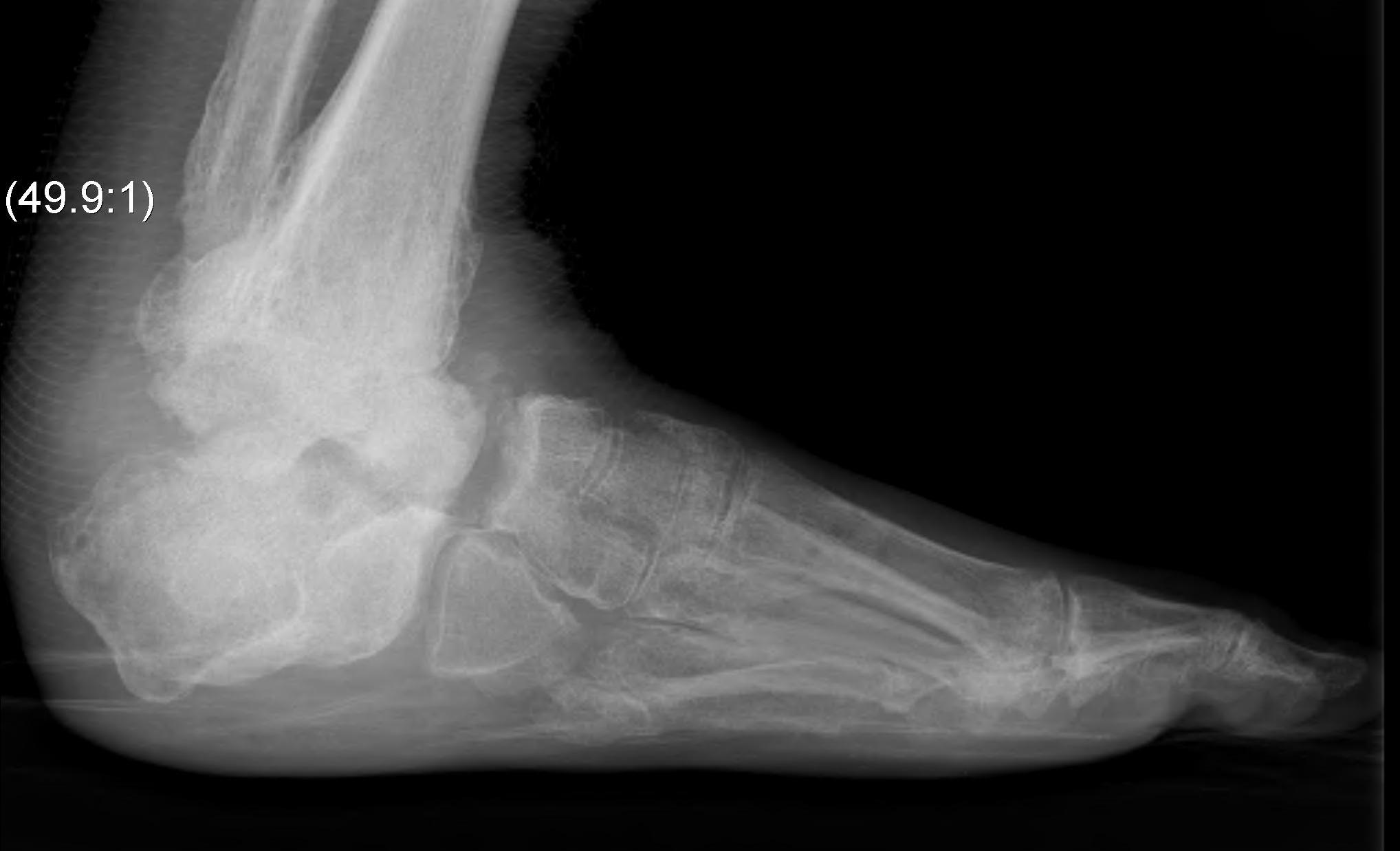 Charcot Joint | The Bone School