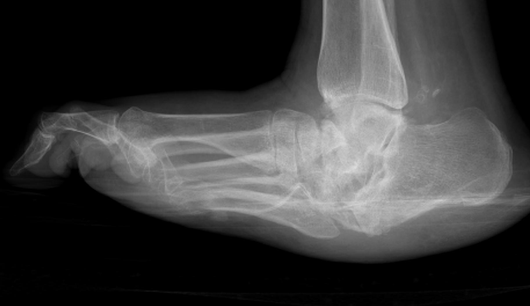 Charcot Foot & Ankle | The Bone School