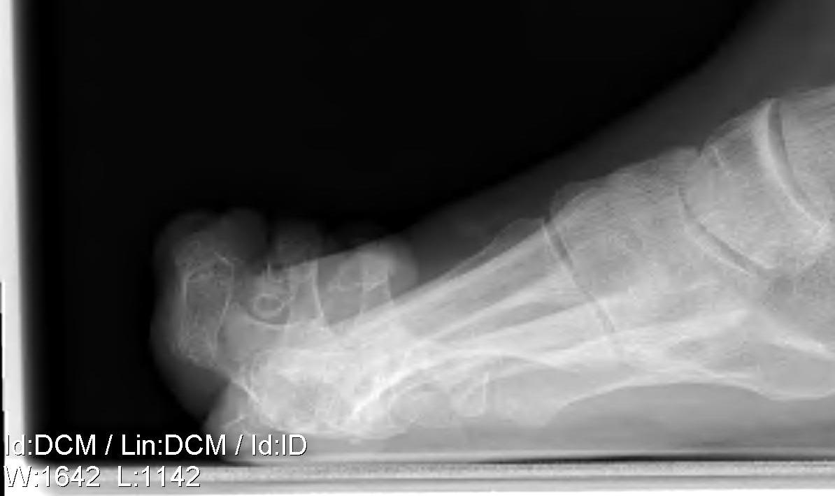 Hammer Toe Xray