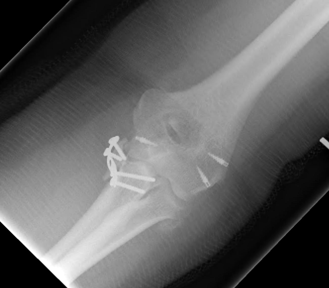 Coronoid process fractures | The Bone School