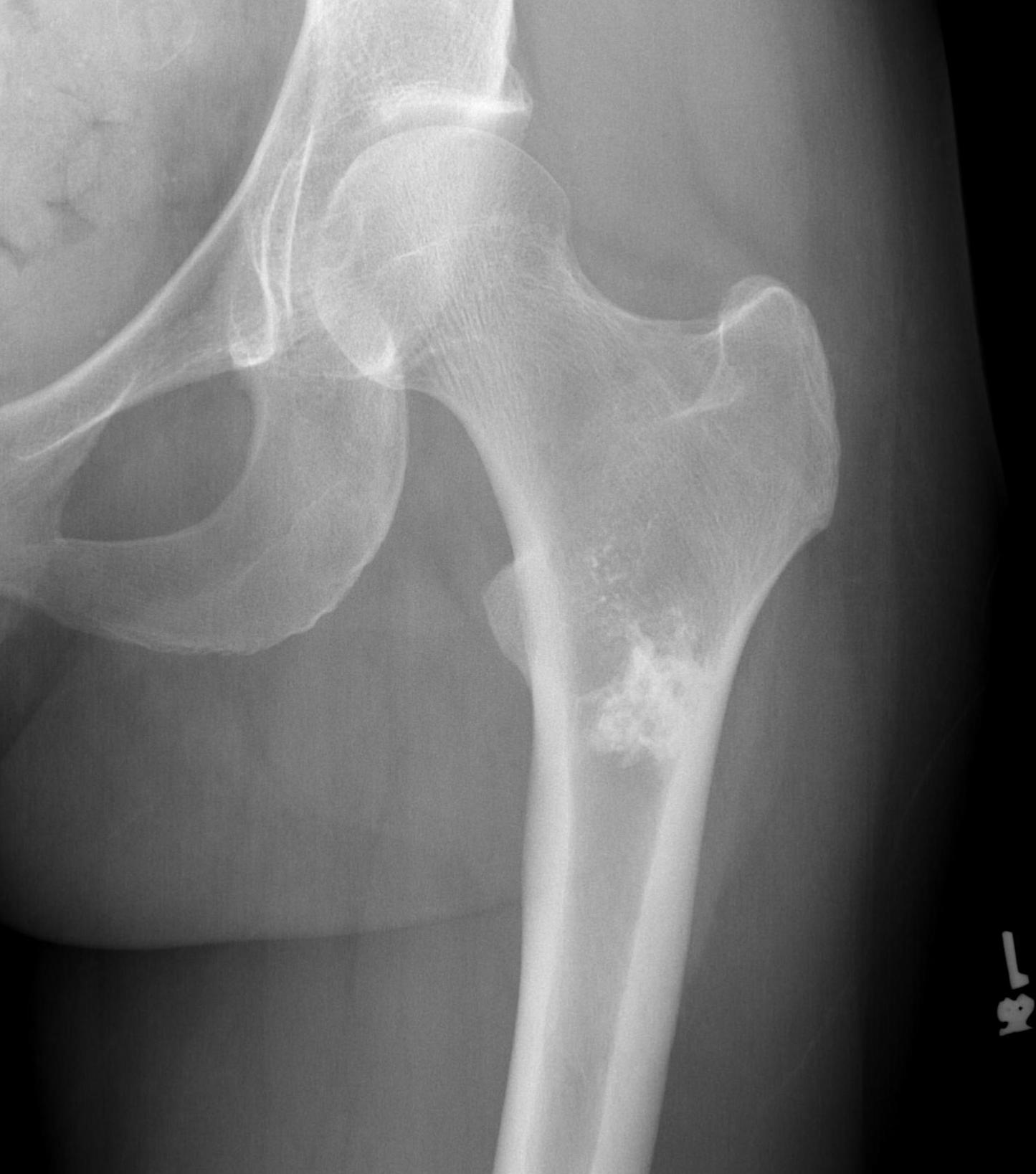 Enchondroma Humerus