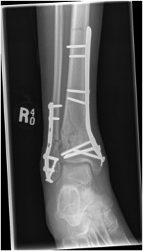 Distal Tibial Fractures | The Bone School