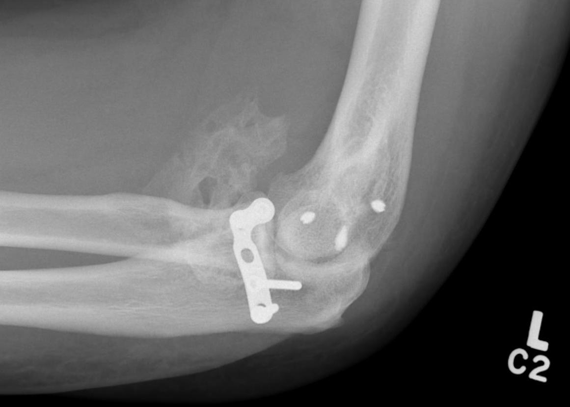 Heterotopic ossification | The Bone School