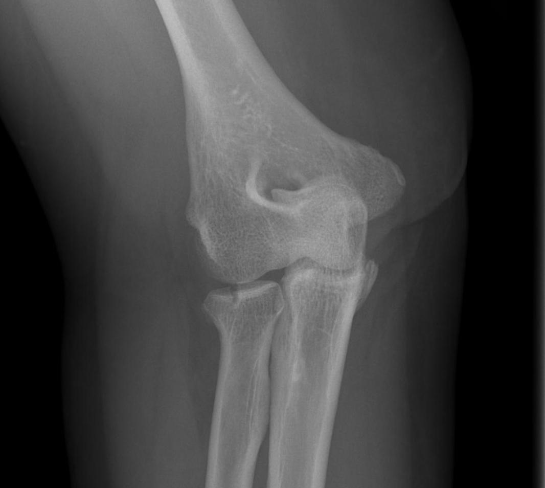 Radial Head Fracture Classification